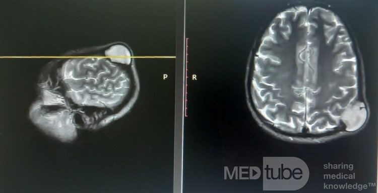 Tumeur Cérébrale • Image • Site médical MEDtube.fr